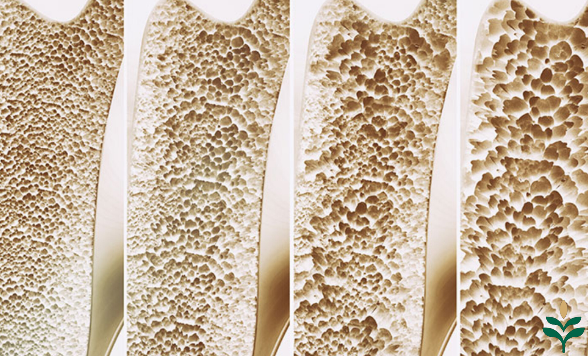 What is Osteoporosis and bone density, 4 stage of Osteoporos