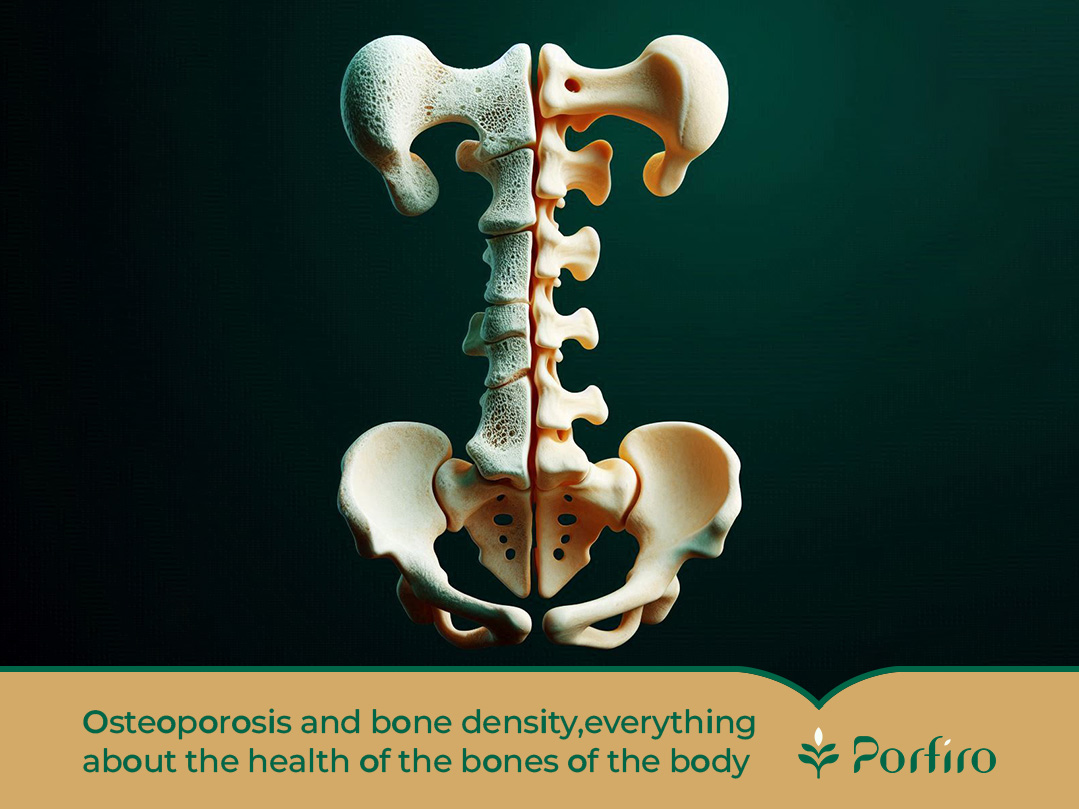 What is Osteoporosis and bone density, 4 stage of Osteoporos